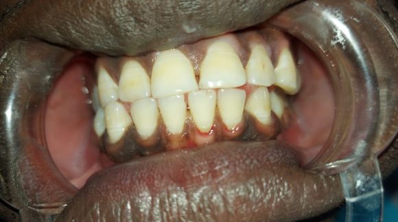 Lake Dental Clinic – Best Dental Services - Nairobi and Kisumu