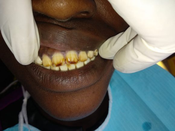 Dental fluorosis, tooth discoloration and remedies in Kenya today