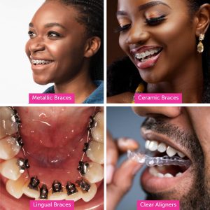 Dental braces in Kenya; your complete guide – Lake Dental Clinic